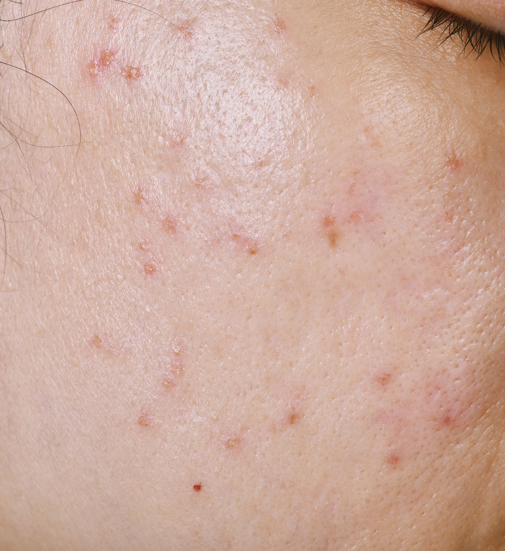 Skin Purging: Why it’s a good thing. – BaseLift